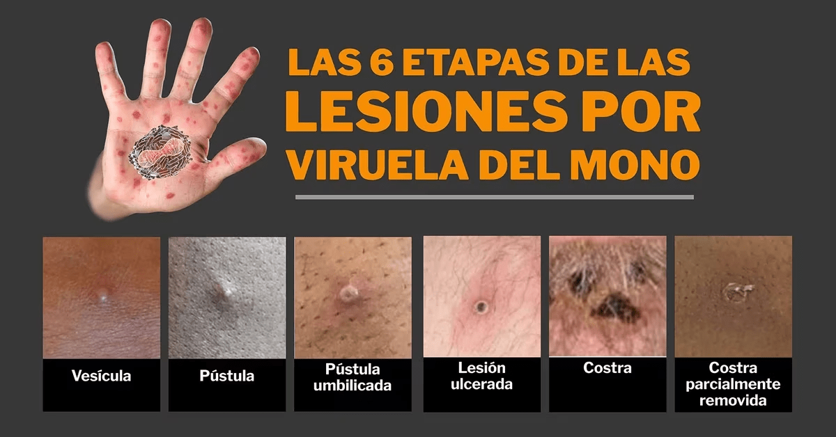 ¿Qué es el Mpox?: La enfermedad que ya cobro cinco vidas en México